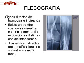 Trombosis venosa profunda | PPT