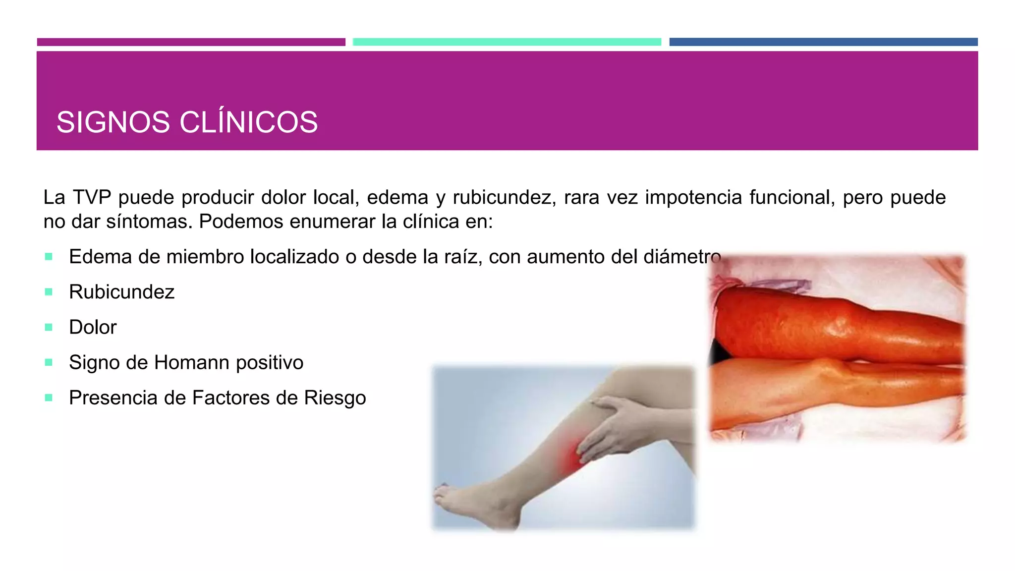 Trombosis venosa profunda | PPTX