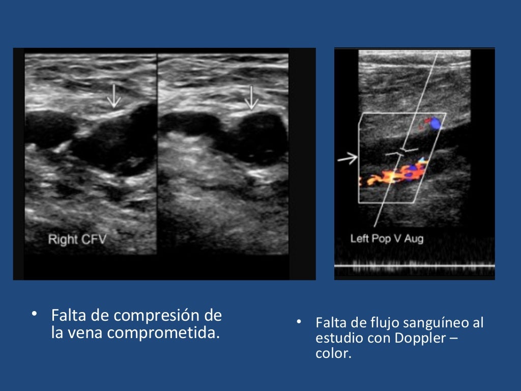 Trombosis venosa profunda en ecografía.