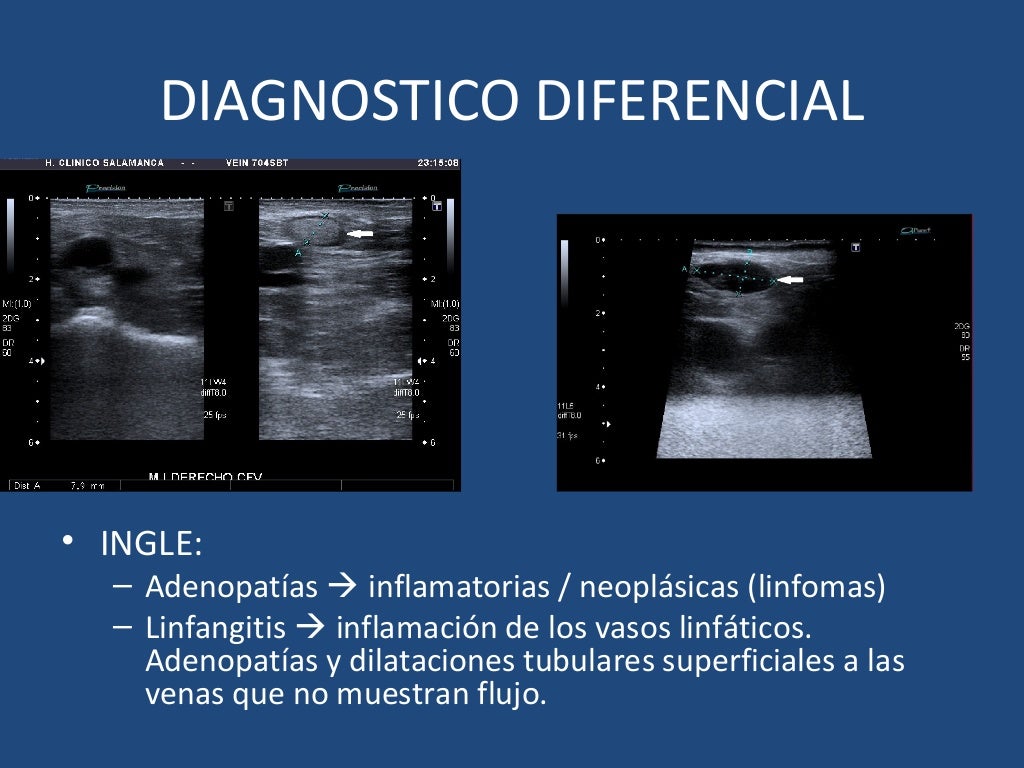 Trombosis venosa profunda en ecografía.