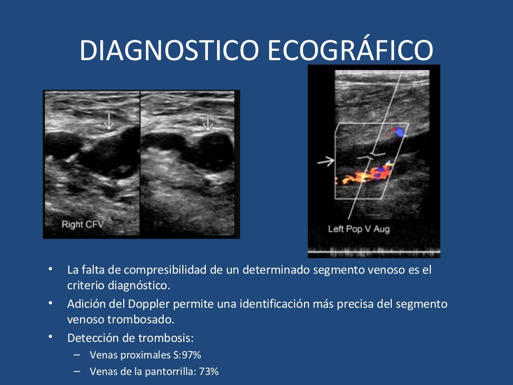 Trombosis venosa profunda en ecografía.