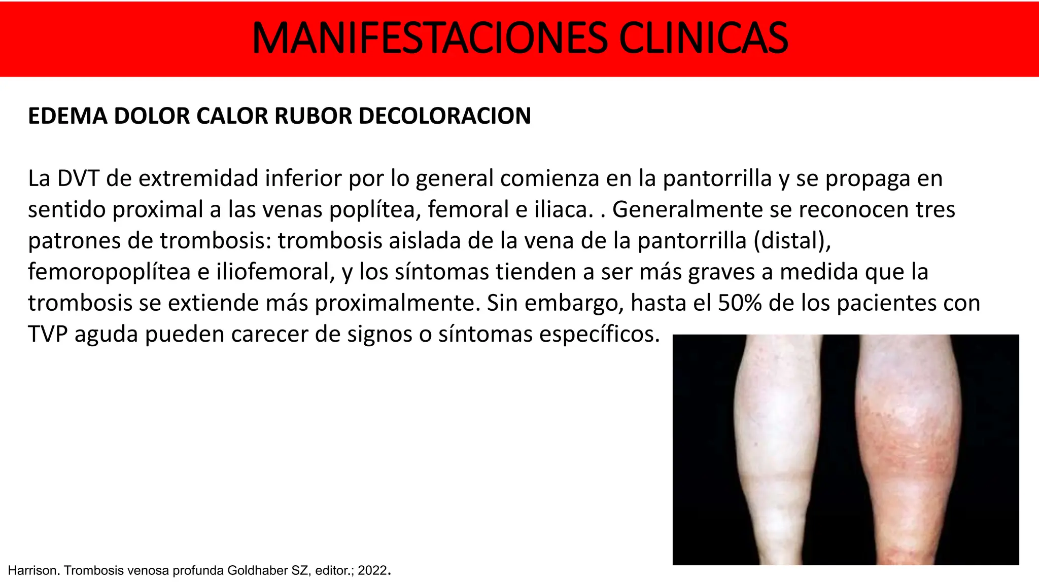 TROMBOSIS VENOSA PROFUNDA medicina interna | PPTX