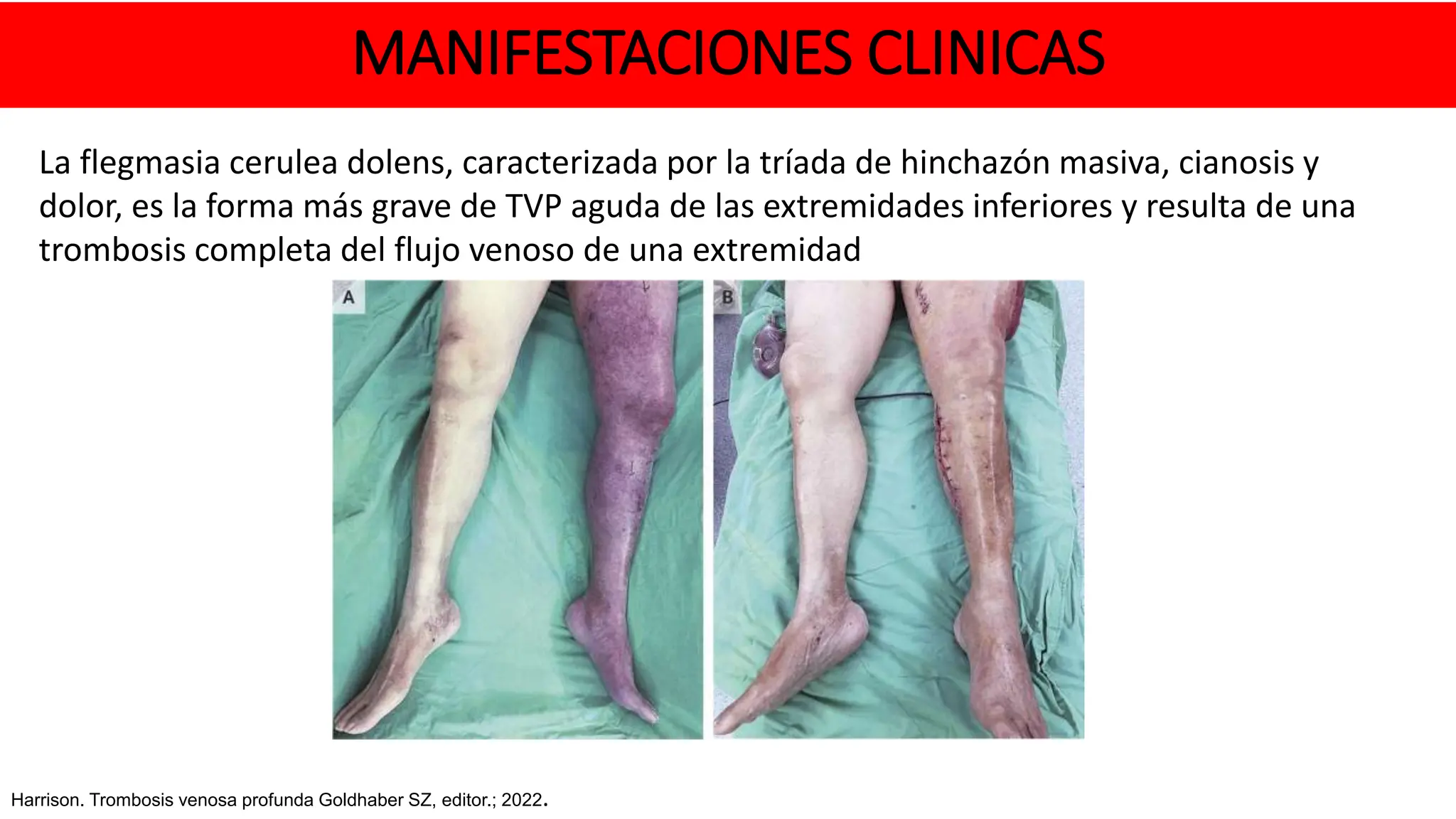 TROMBOSIS VENOSA PROFUNDA medicina interna | PPTX