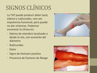 TROMBOSIS VENOSA PROFUNDA 2024 (1)documento | PDF