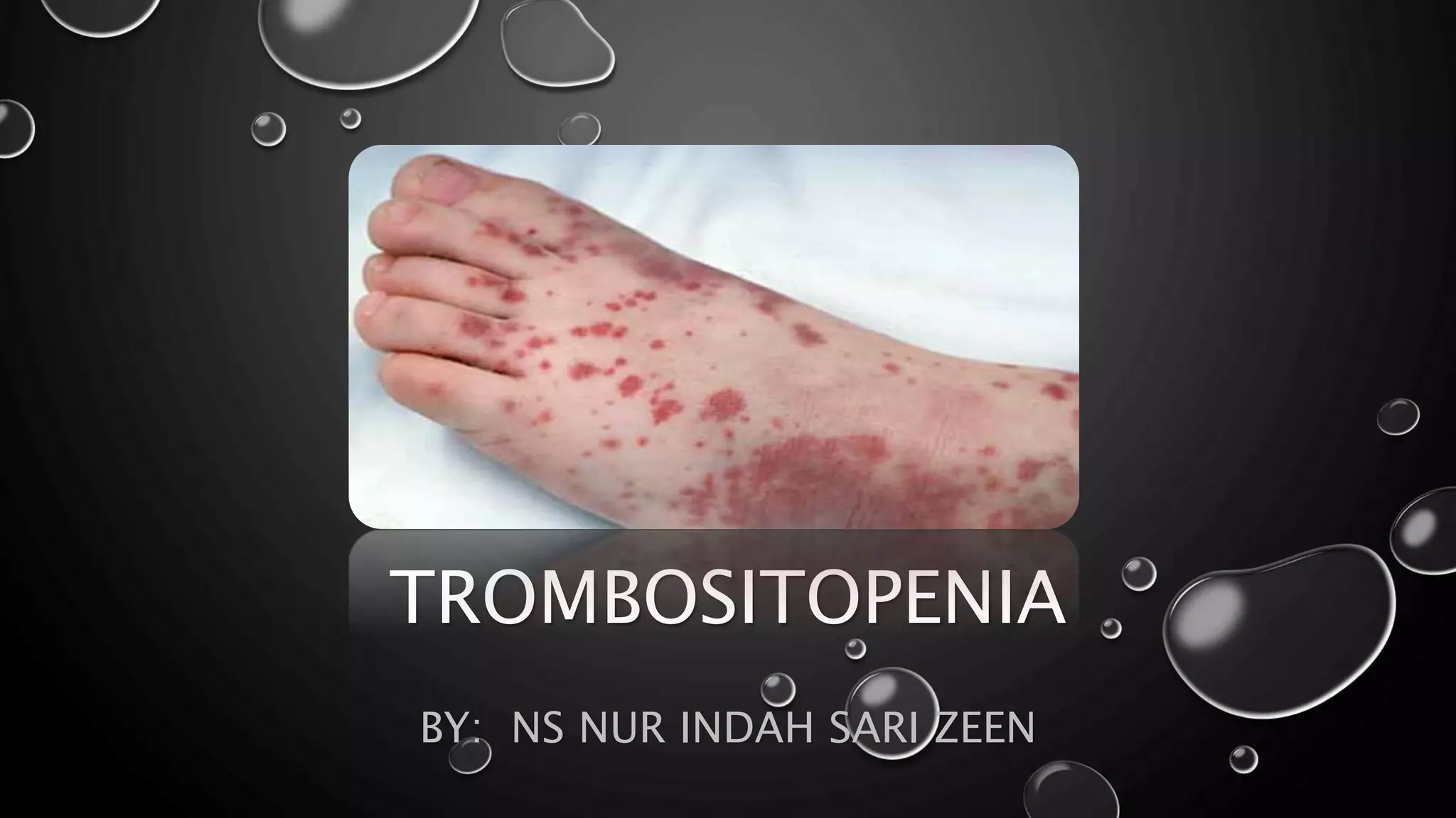 Askep Trombositopenia | PPTX
