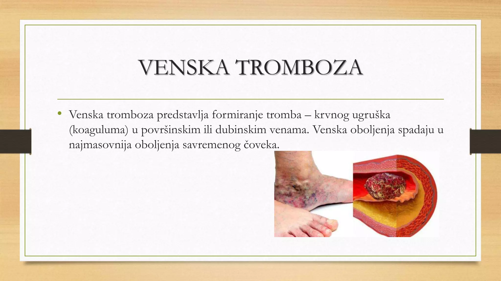 Tromboza & Embolija | PPTX