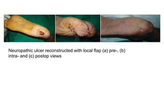 trophic ulcer.pptx