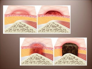 Trophic ulcers | PPT