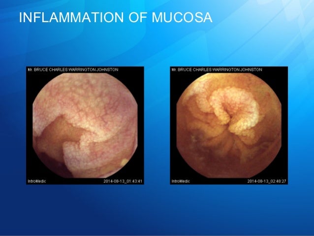 Tropical Sprue, Dr PHẠM CHÍ TÒAN, MEDIC CENTER, VIETNAM