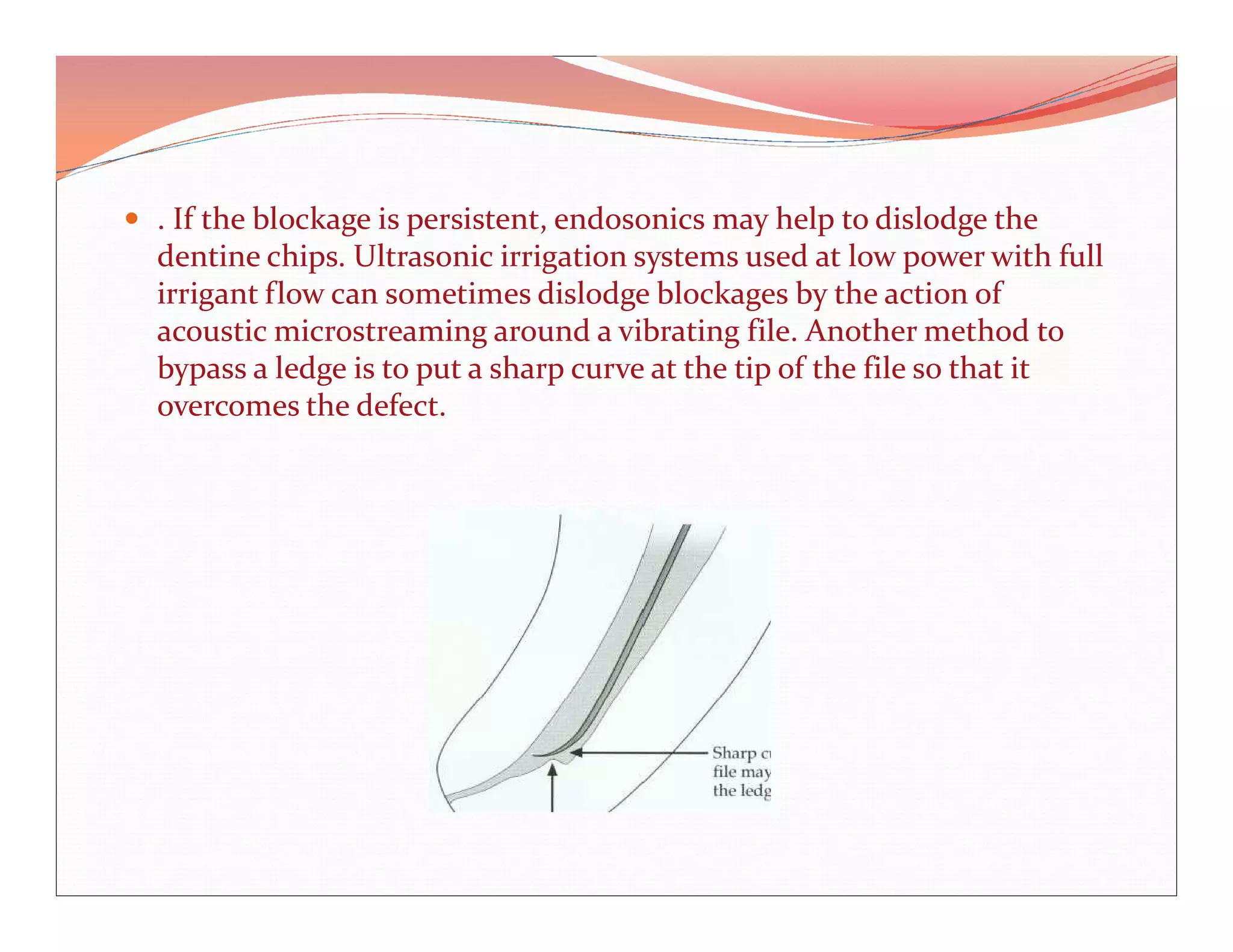 Trouble shooting in endodontics | PDF