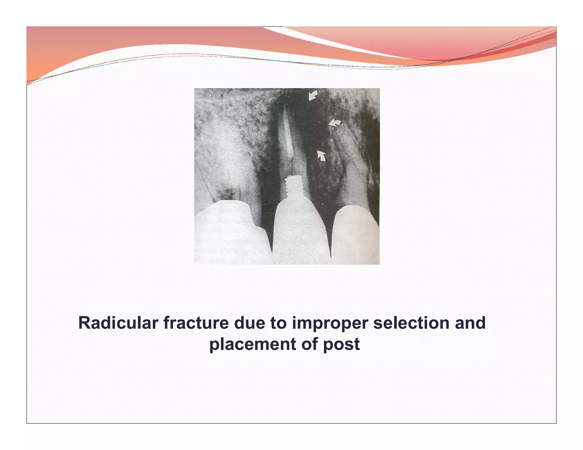 Trouble shooting in endodontics | PDF