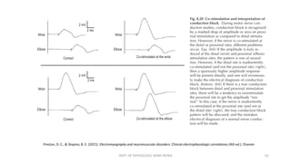 Troubleshooting in Nerve Conduction and EMG Studies : Technical Errors ...