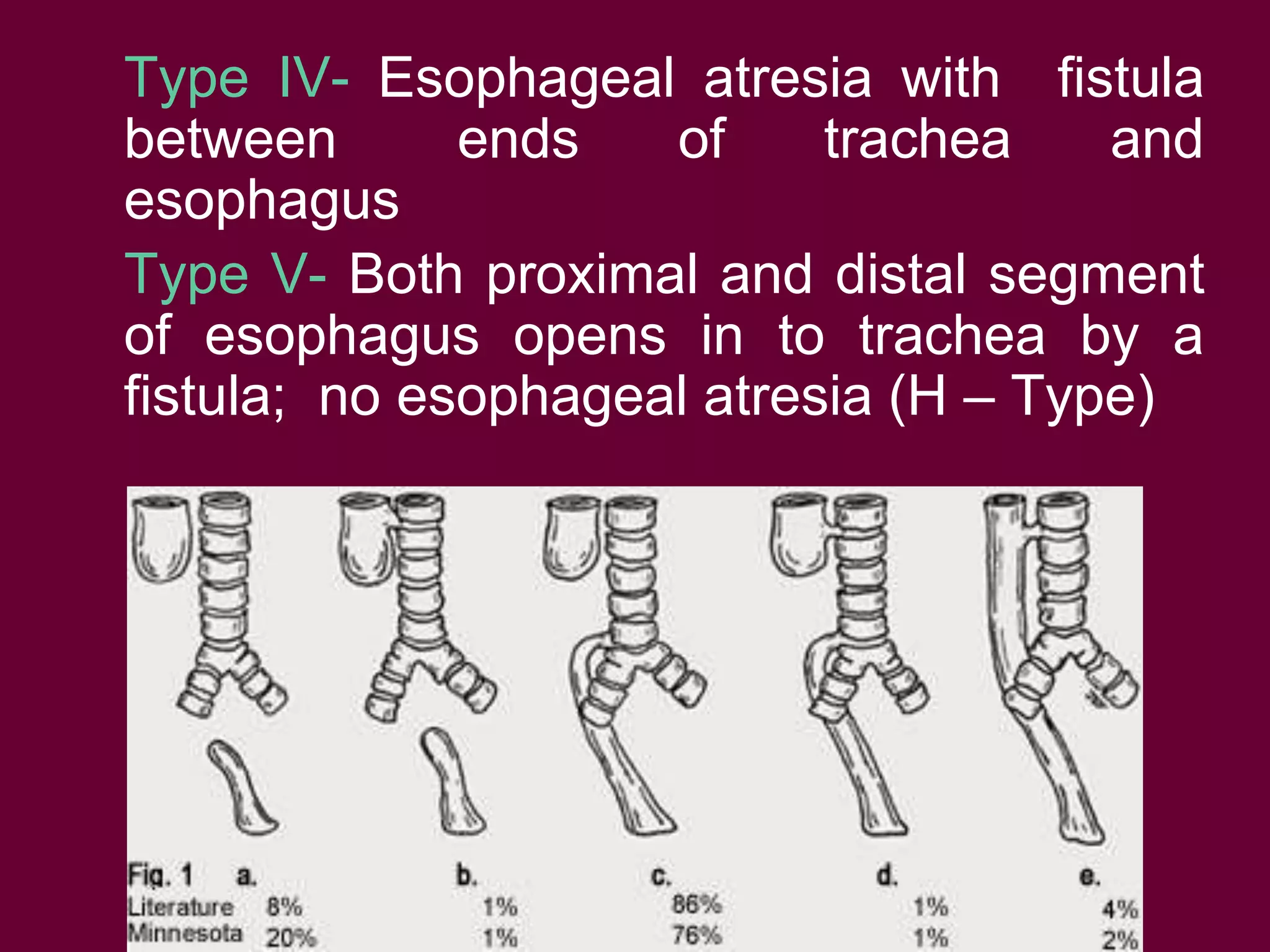 Tracheoesophageal Fistula | PPT