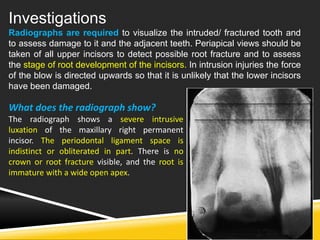 Trauma to an immature incisor | PPT