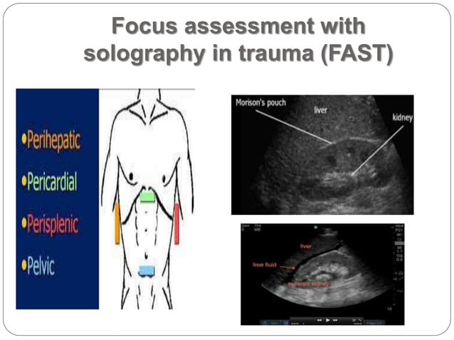 Truama management advance trauma support.pptx