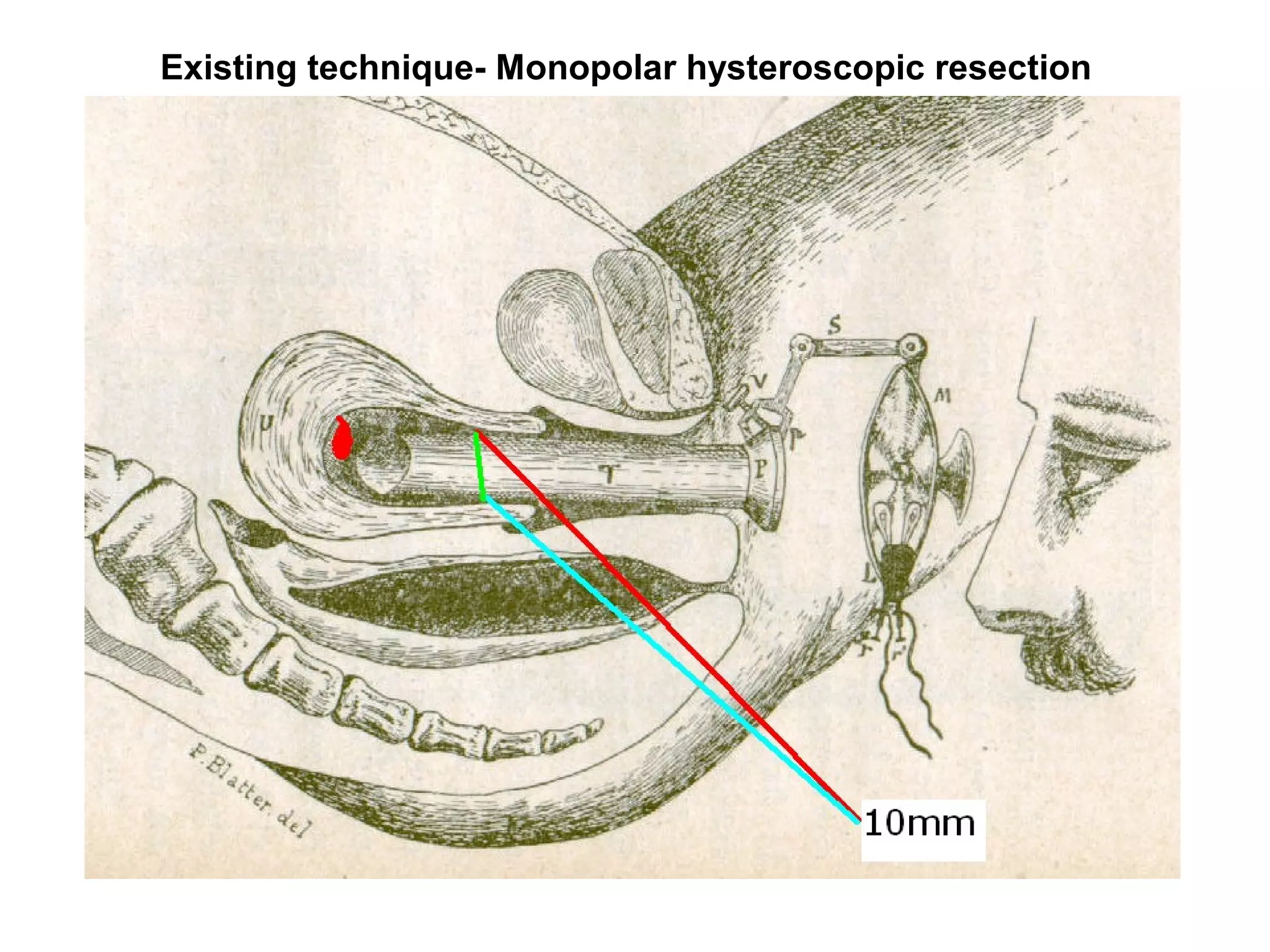 Uterine polyps: Modern Management | PPT