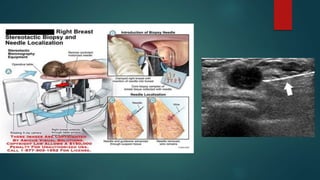 core biopsy of breast | PPTX