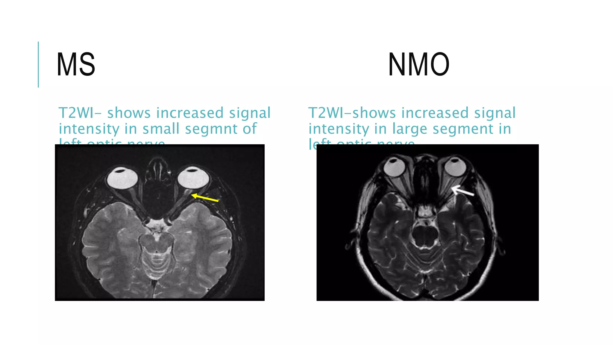 Optic Disc Swelling | PPTX | Eye and Vision Conditions | Diseases and ...