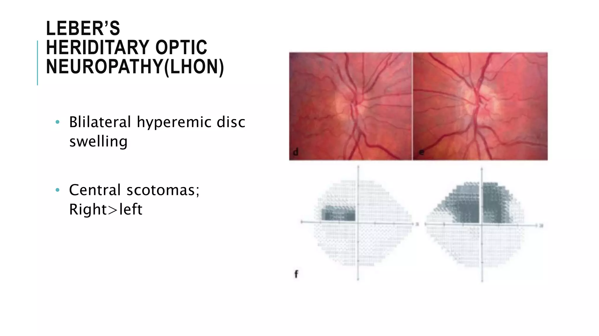 Optic Disc Swelling | PPT