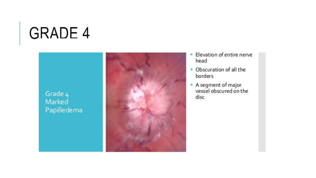 Optic Disc Swelling | PPTX | Eye and Vision Conditions | Diseases and ...