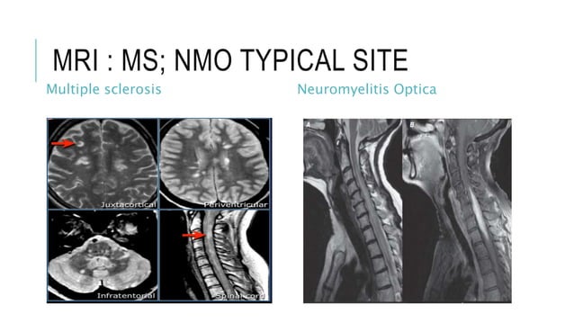 Optic Disc Swelling | PPTX | Eye and Vision Conditions | Diseases and ...