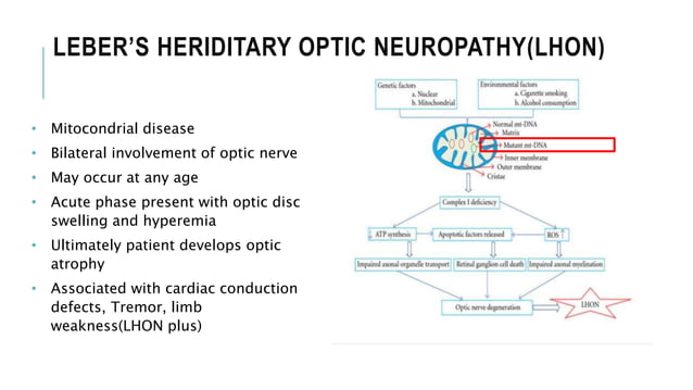 Optic Disc Swelling | PPTX | Eye and Vision Conditions | Diseases and ...