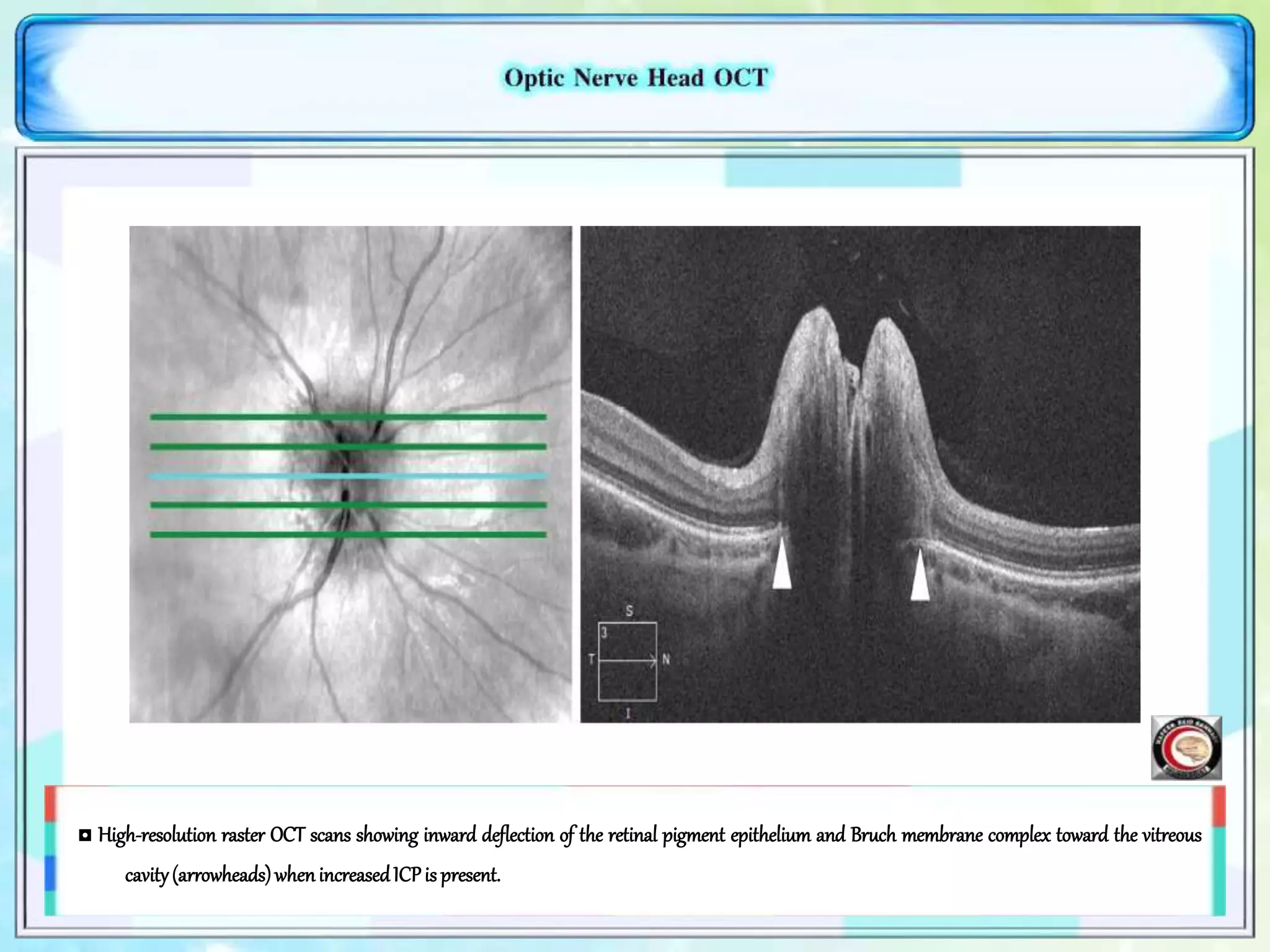 True vs. pseudo papilledema, Dr. Jekyll and Mr. Hyde | PPTX