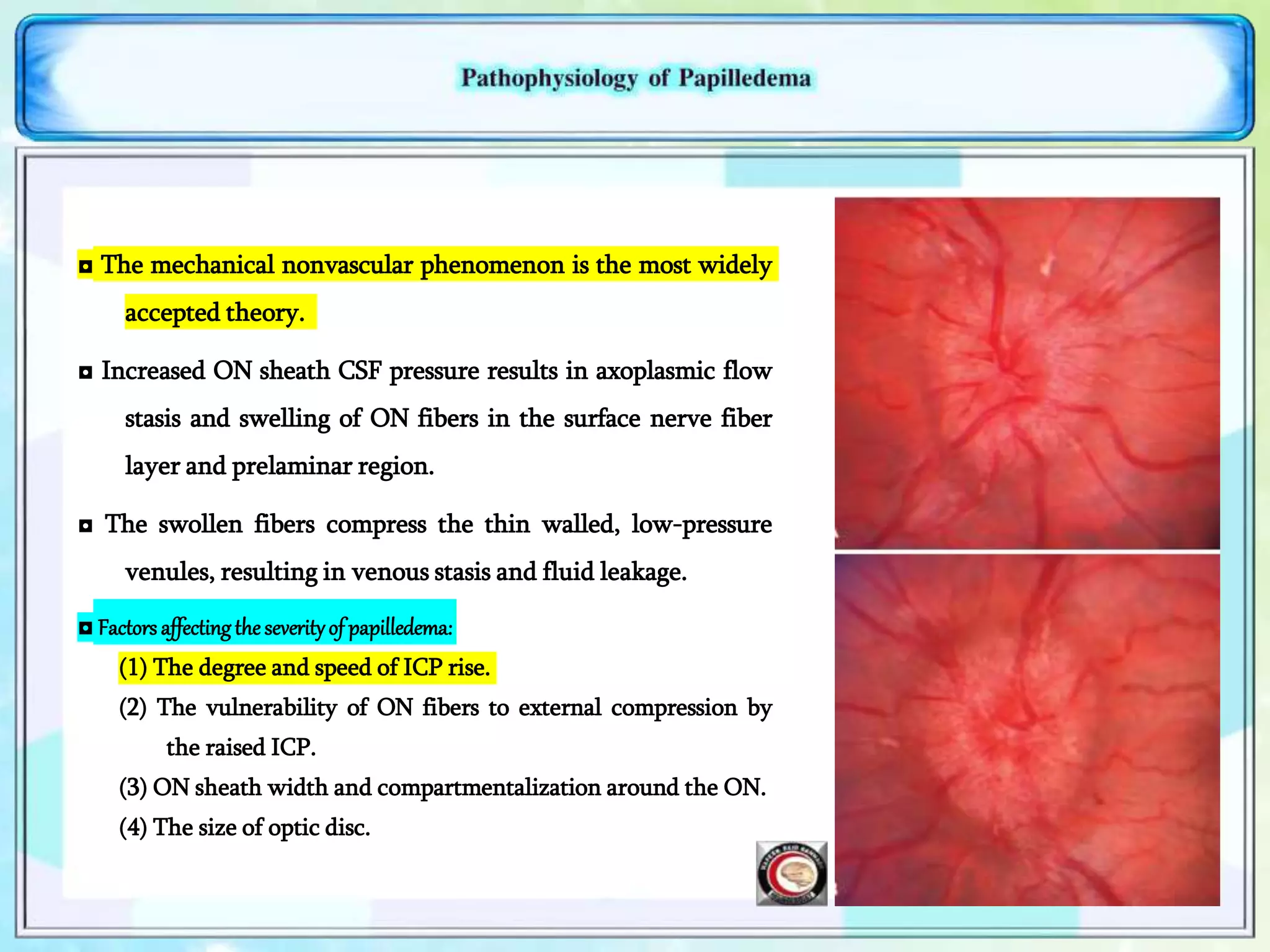 True vs. pseudo papilledema, Dr. Jekyll and Mr. Hyde | PPTX