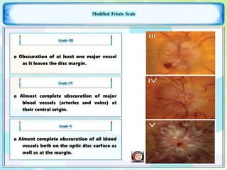 True vs. pseudo papilledema, Dr. Jekyll and Mr. Hyde | PPTX