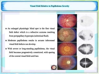 True vs. pseudo papilledema, Dr. Jekyll and Mr. Hyde | PPTX