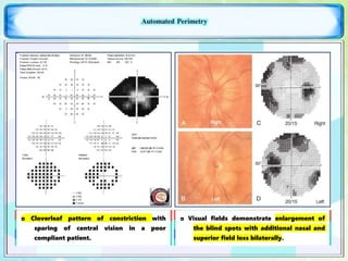 True vs. pseudo papilledema, Dr. Jekyll and Mr. Hyde | PPTX