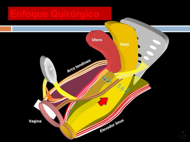 Importancia De La Preservación Del Anillo Pericervical En | PPT