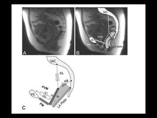Importancia De La Preservación Del Anillo Pericervical En