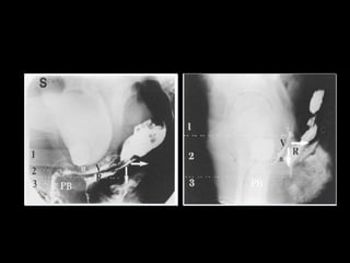Importancia De La Preservación Del Anillo Pericervical En