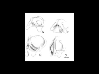 Importancia De La Preservación Del Anillo Pericervical En | PPT