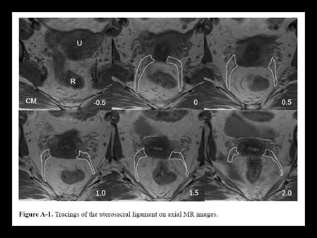 Importancia De La Preservación Del Anillo Pericervical En