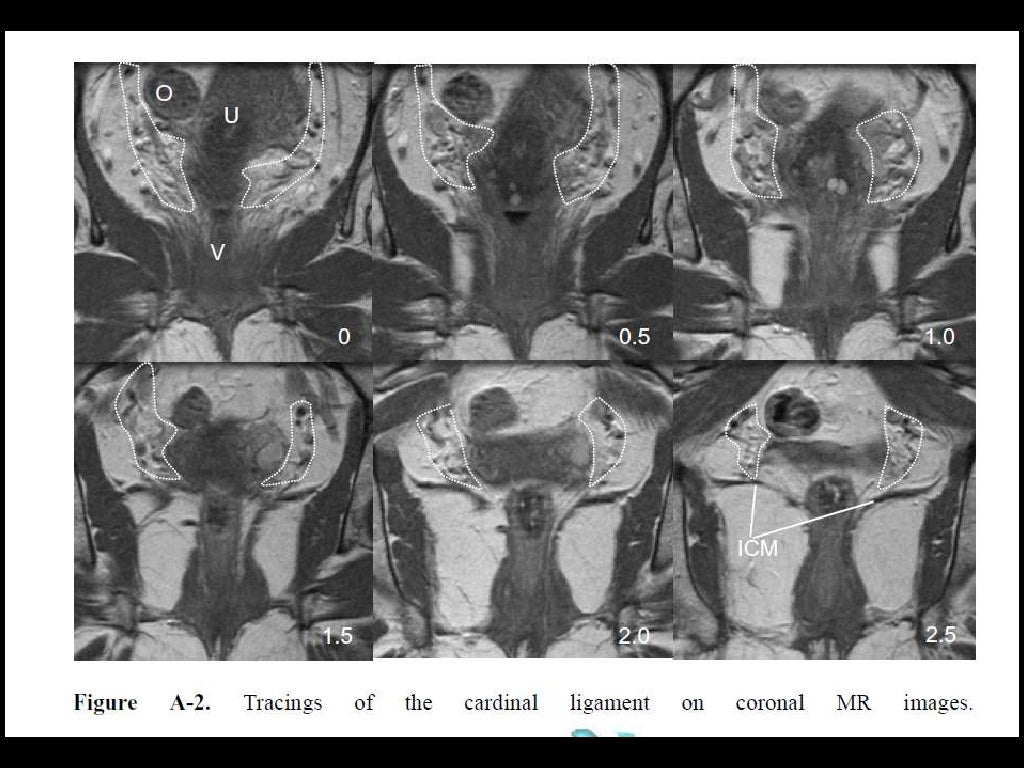 Importancia De La Preservación Del Anillo Pericervical En