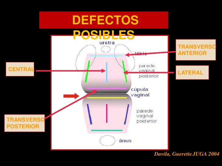 Importancia De La Preservación Del Anillo Pericervical En