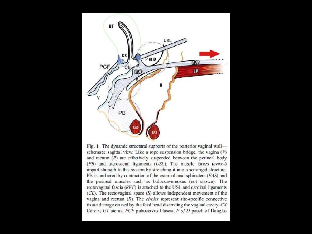 Importancia De La Preservación Del Anillo Pericervical En