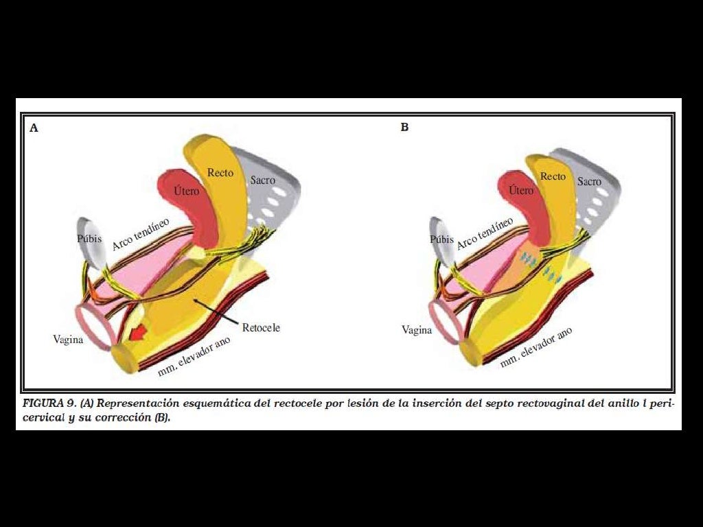 Importancia De La Preservación Del Anillo Pericervical En