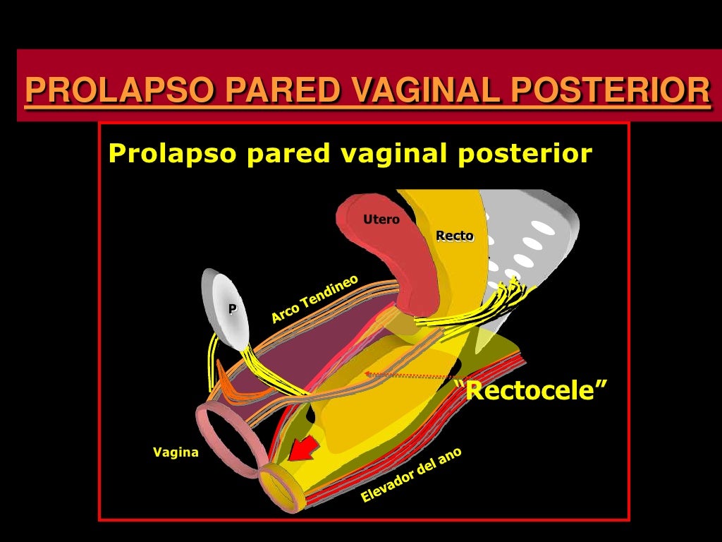 Importancia De La Preservación Del Anillo Pericervical En