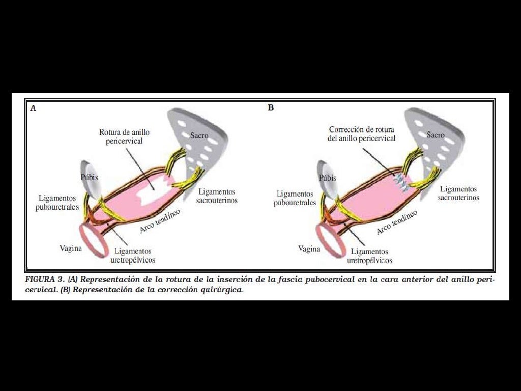Importancia De La Preservación Del Anillo Pericervical En