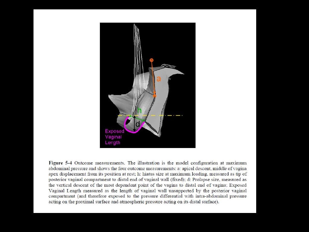 Importancia De La Preservación Del Anillo Pericervical En