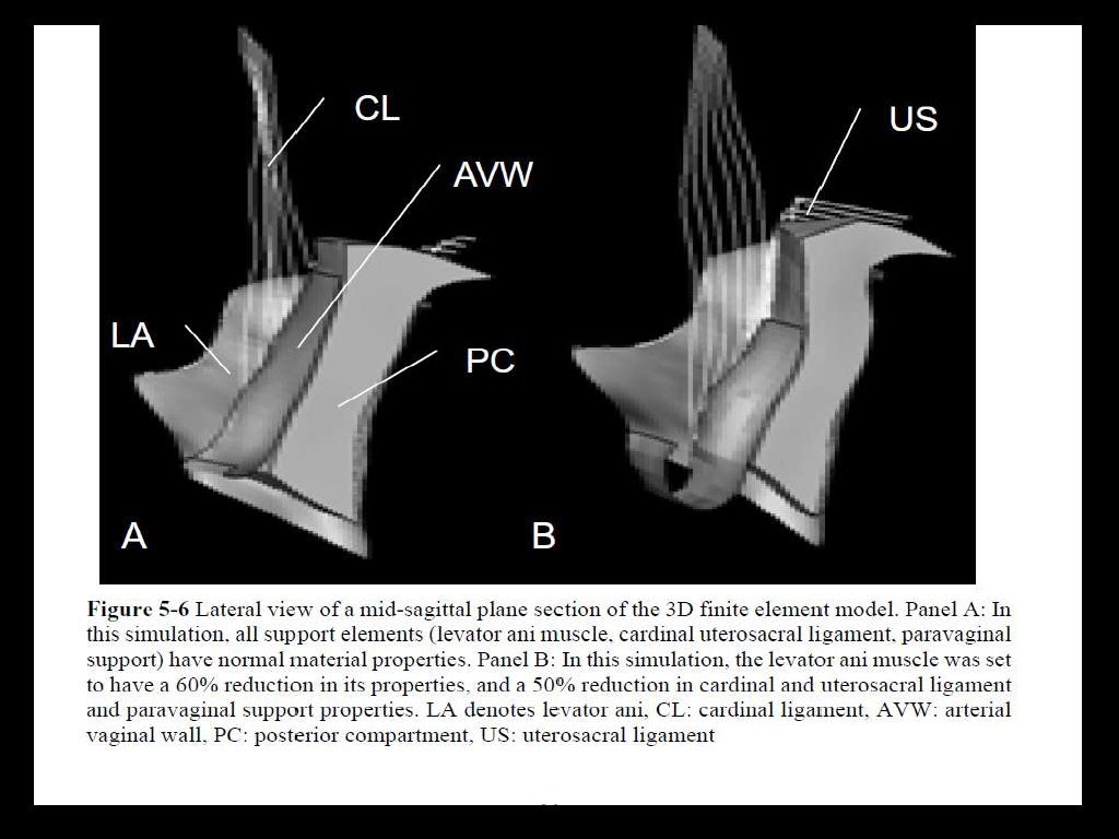 Importancia De La Preservación Del Anillo Pericervical En