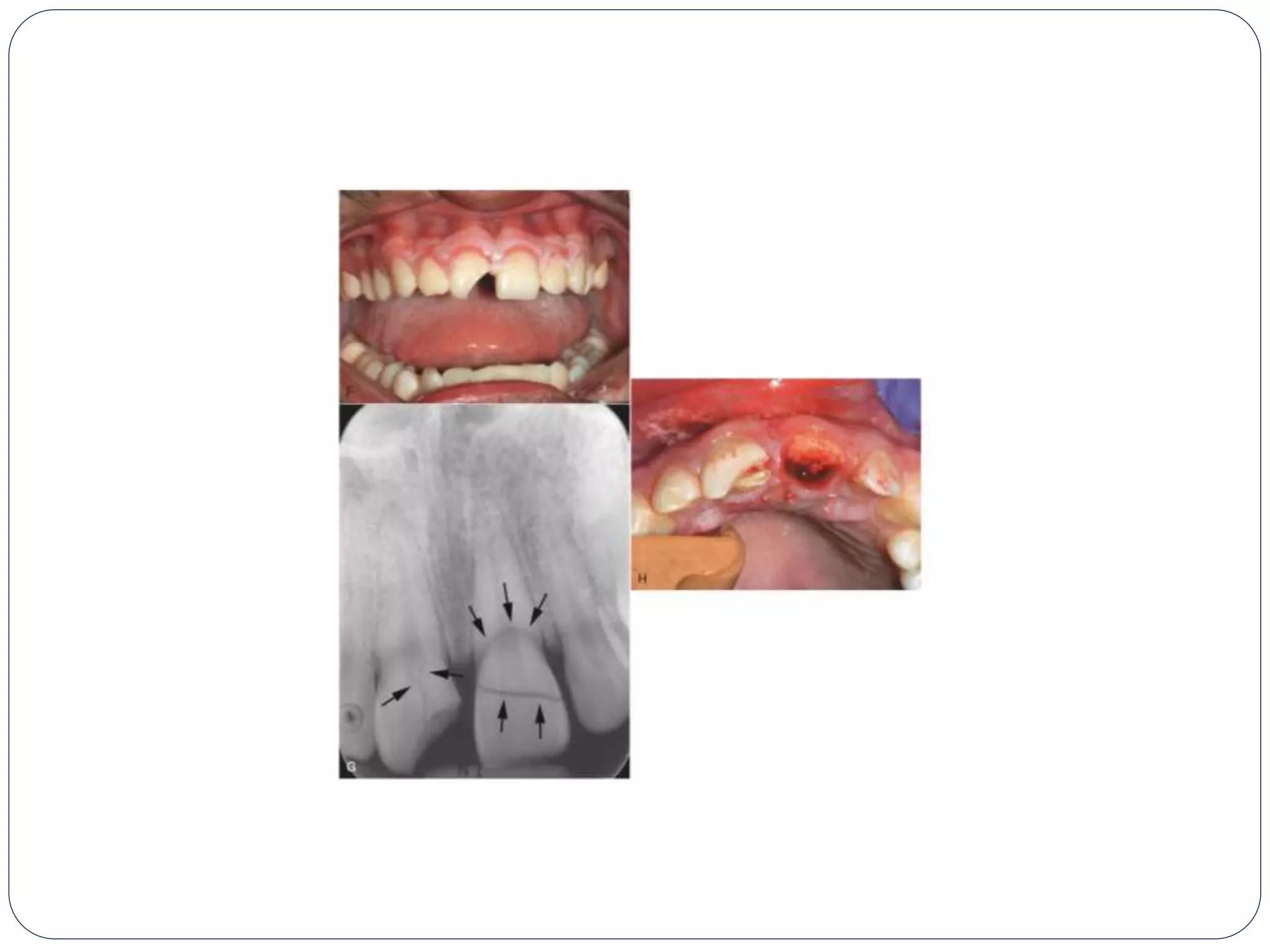 facial soft tissue and dentoalveolar trauma | PPTX