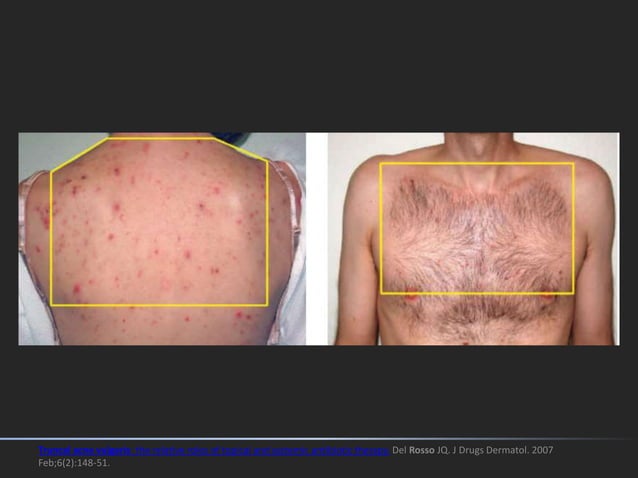 Truncal acne: evidence for treatment