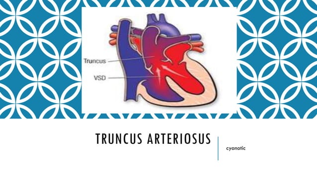 Truncus arteriosus | PPT