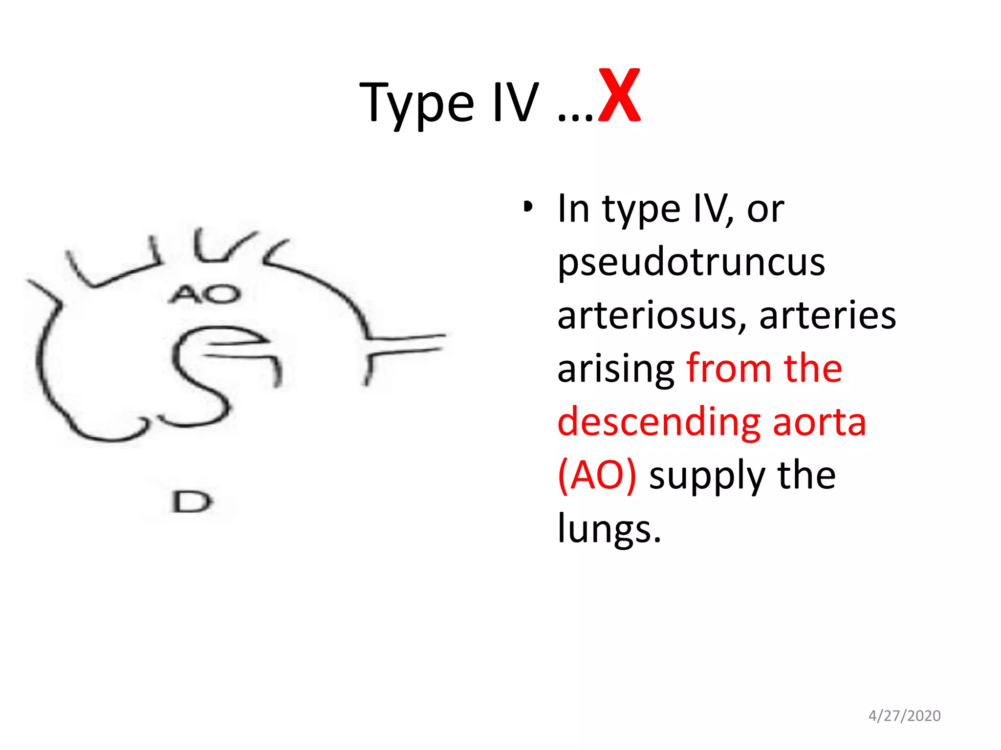 Truncus arteriosus | PPT