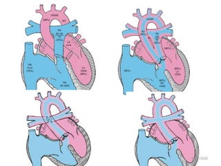 Truncus arteriosus | PPT