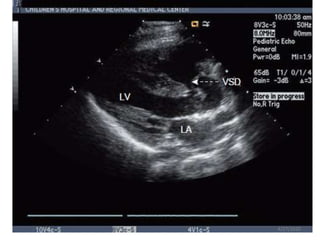 Truncus Arteriosus Echo